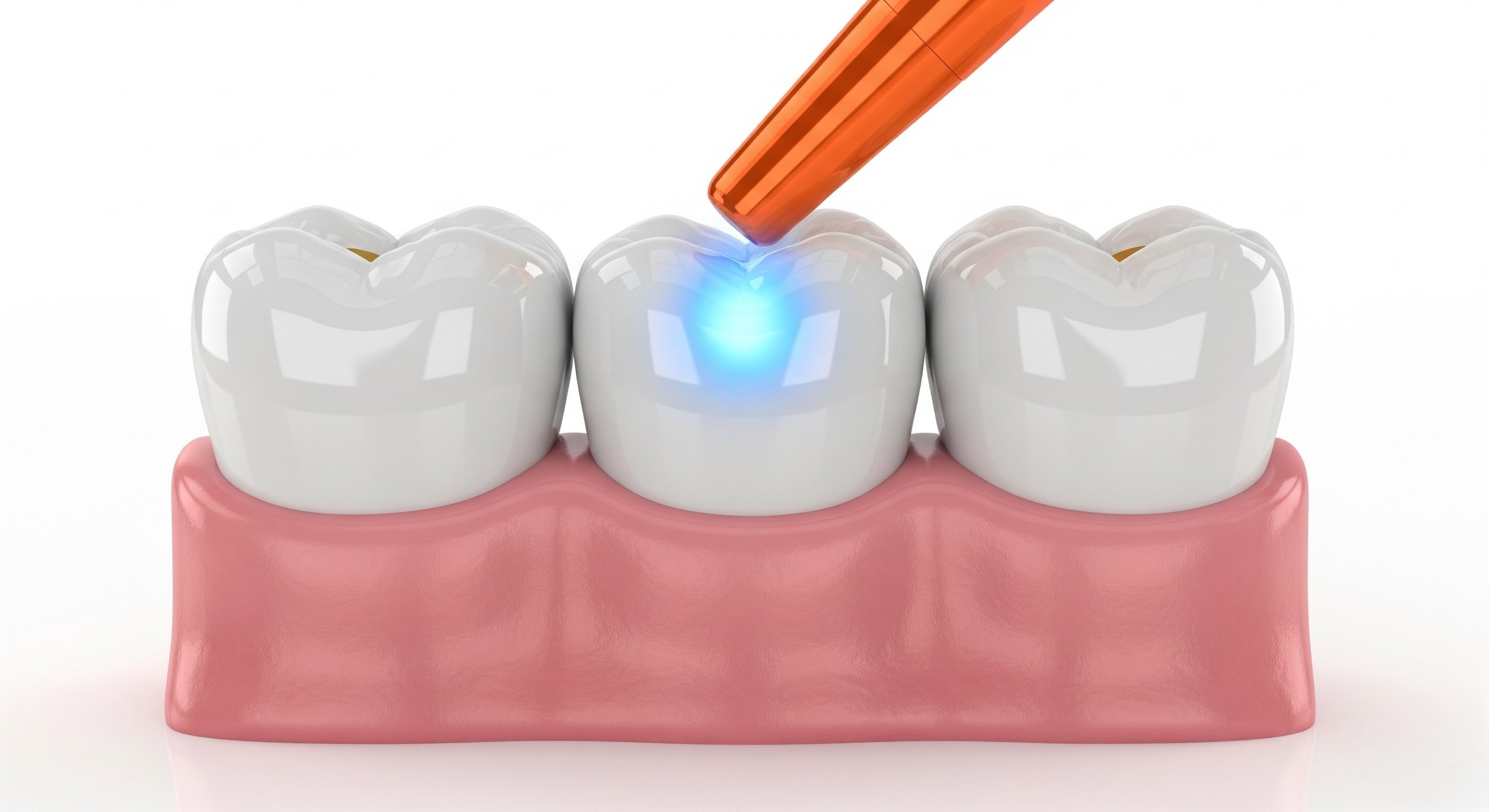 Composite Fillings Cost and Pricing Information in {CLINIC_CONFIG.city}