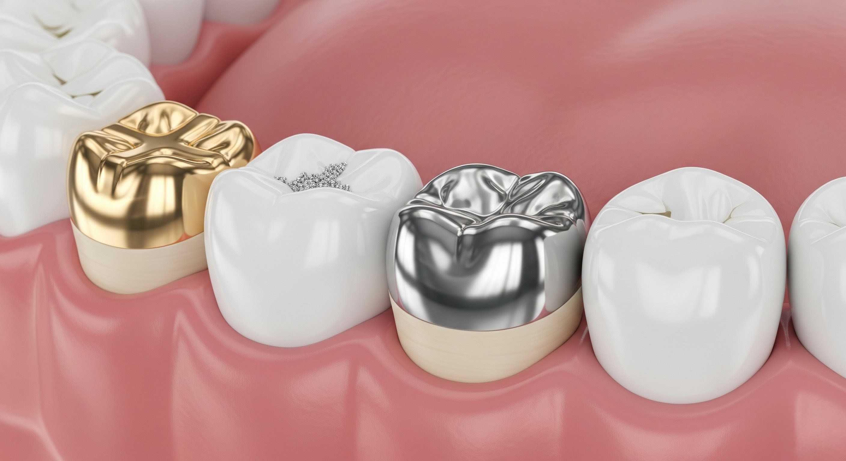 Types of Dental Fillings